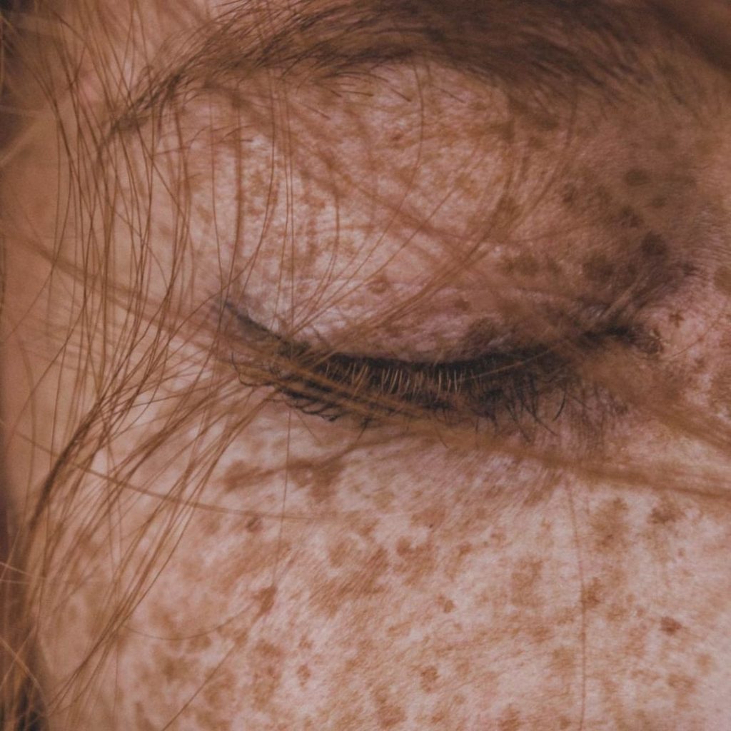 Por qué salen manchas en la piel y cómo acabar con ellas