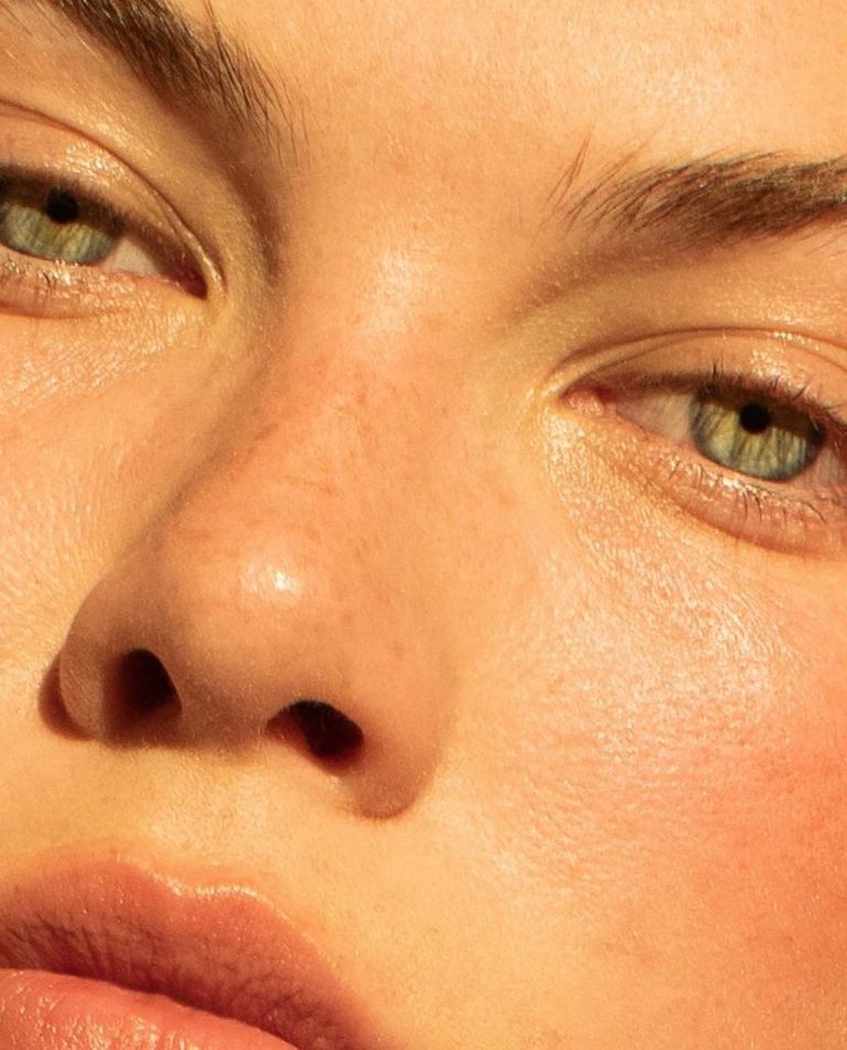 ¿Qué es la rosácea? Síntomas, causas y factores de riesgo