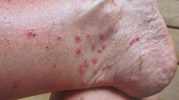 Cómo identificar las picaduras de insectos paso a paso