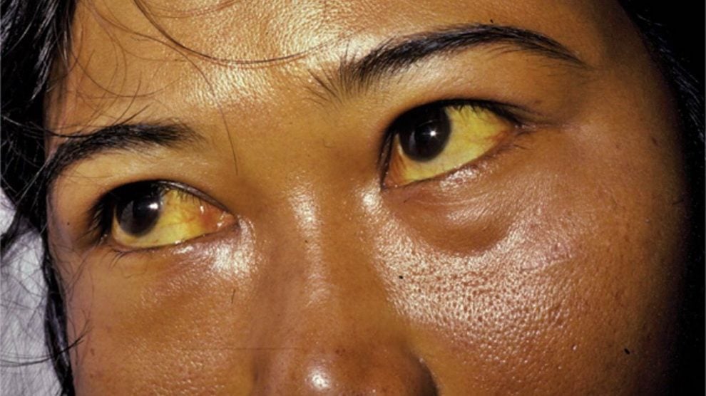 Por Qué Los Ojos Se Ponen Amarillos Causas De La Ictericia