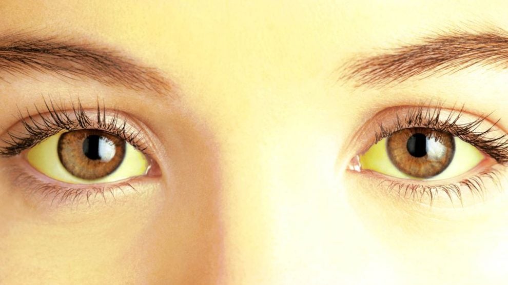 ¿Por qué los ojos se ponen amarillos? Causas de la ictericia