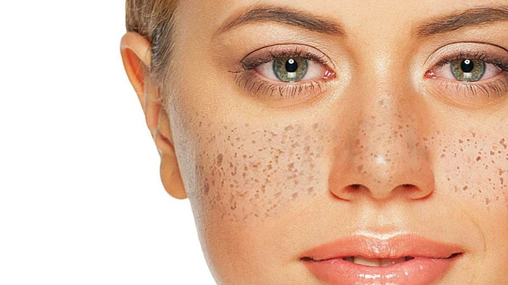 Qué son y cómo se producen las pecas