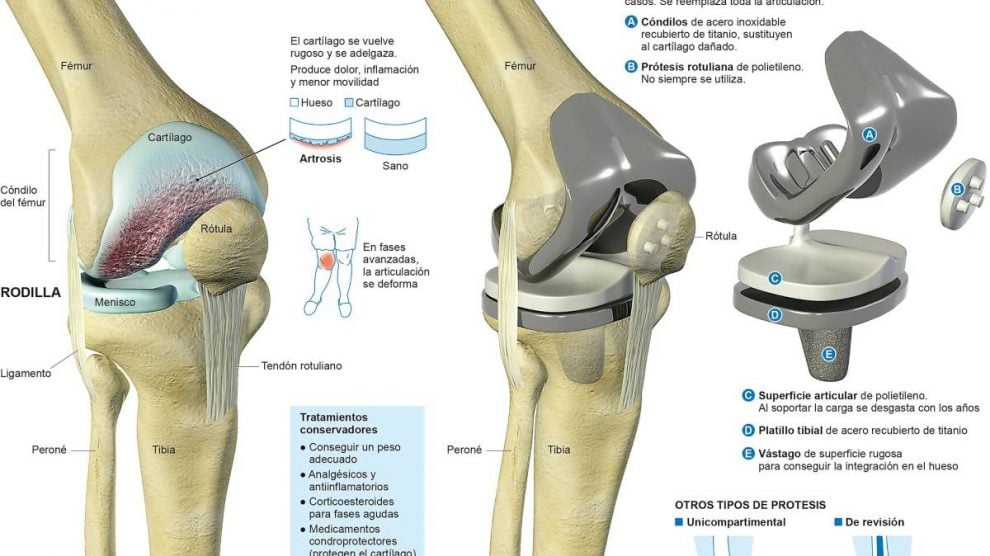 Prótesis de rodilla: Todo sobre la operación y la recuperación