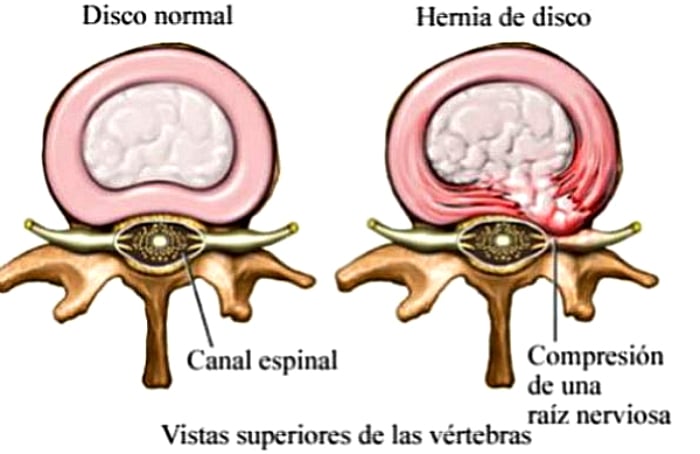 Cómo vivir con una protusión discal: pasos que te ayudarán