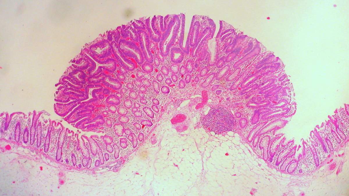 Adenoma: ¿Qué órganos corren el riesgo de padecer el tumor?