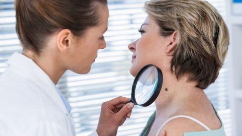 Cómo tratar los acrocordones con remedios naturales