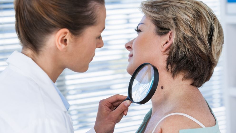 Cómo tratar los acrocordones con remedios naturales