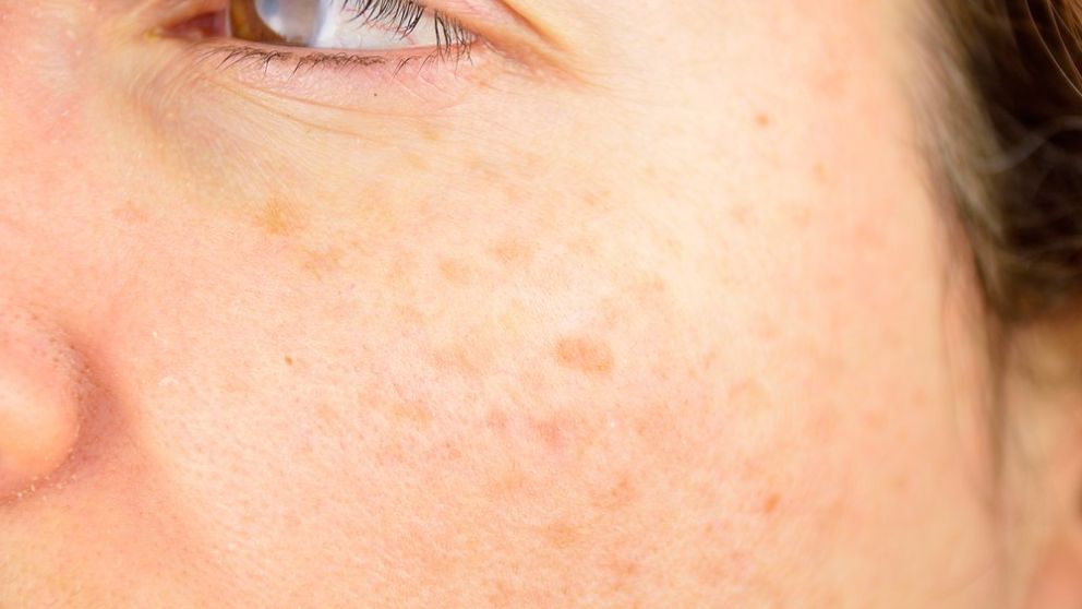 Cómo quitar las manchas de café de la cara con diferentes mascarillas