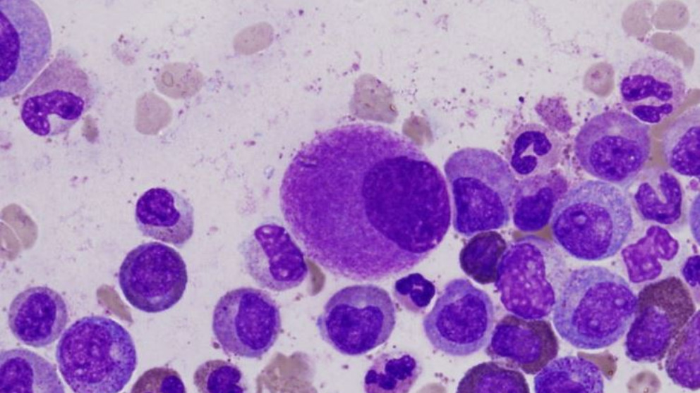 Descubre los diferentes tipos de leucemia