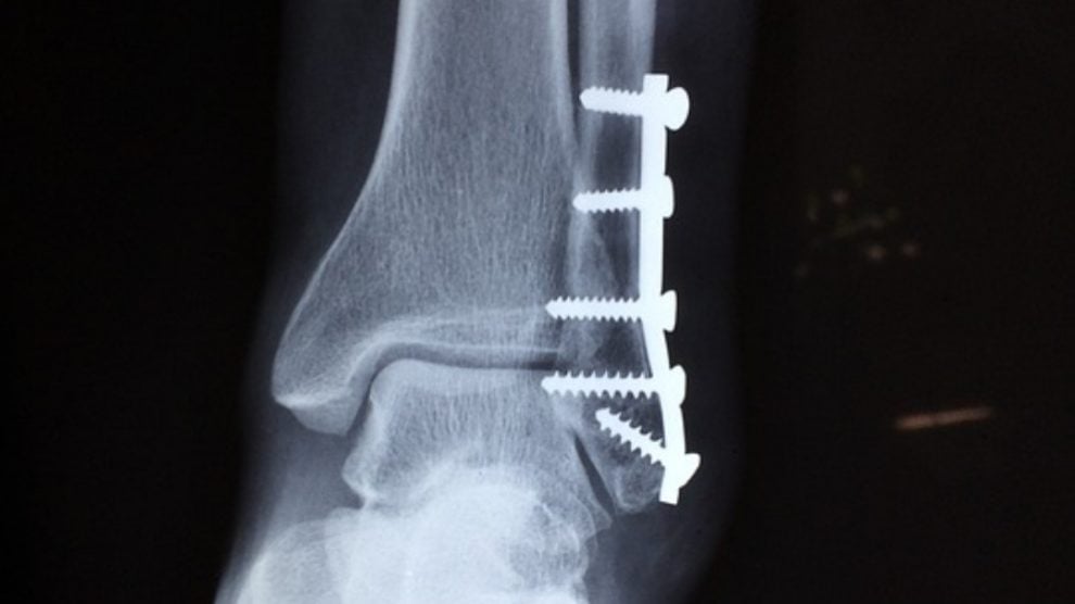 Fractura patológica: Definición y causas