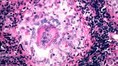 Granuloma: Tipos y síntomas