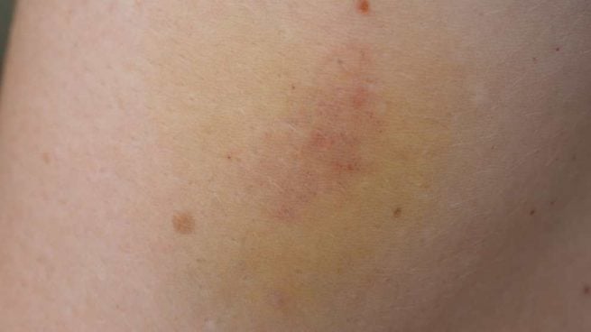 La equimosis, causas y tratamiento