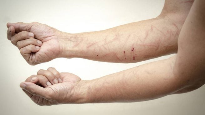 ¿Por qué se produce la equimosis y cómo se cura?