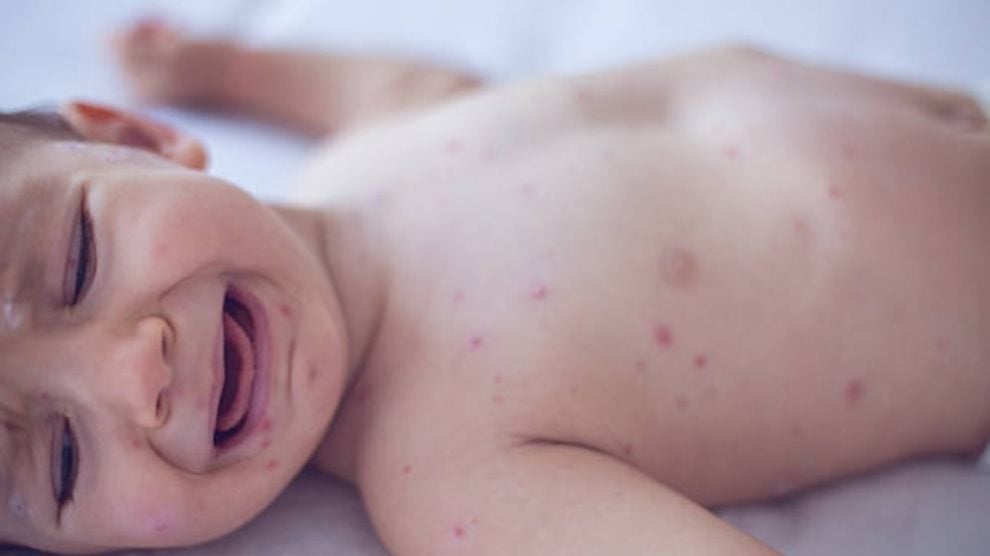 Exantema del bebé: Cuáles son las enfermedades exantemáticas