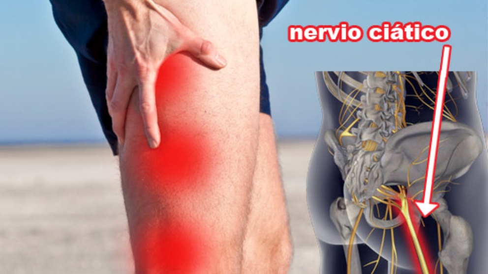 5 tips para prevenir la ciática