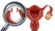 ¿En qué casos es aconsejable la ligadura de trompas?