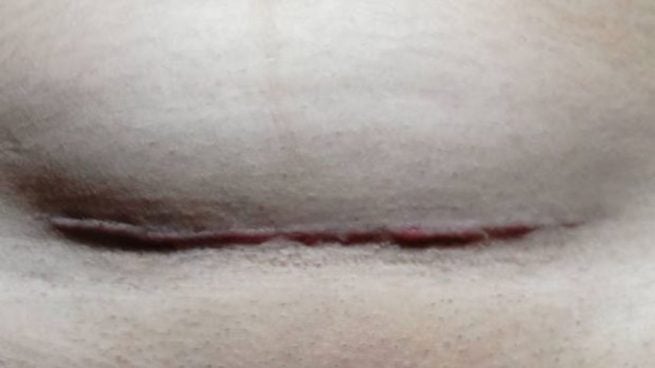 Istmocele por cesárea: Qué es y cuáles son sus consecuencias