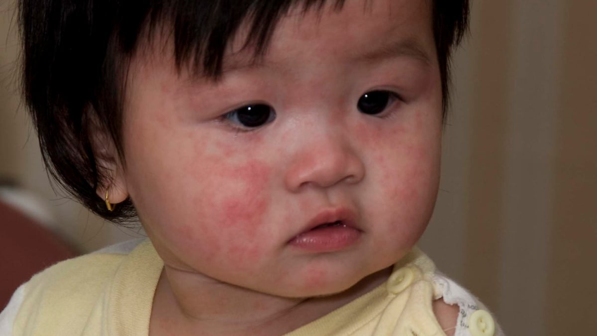 Lo que debes saber sobre la rubeola