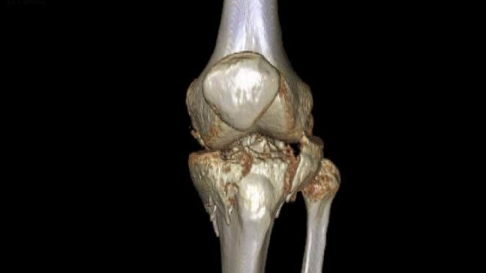 Tratamiento de urgencia de un hueso dislocado