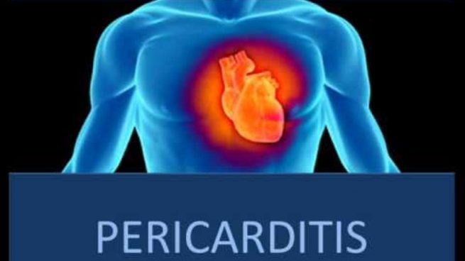 Pericarditis: qué es, síntomas, causas y tratamientos de esta enfermedad