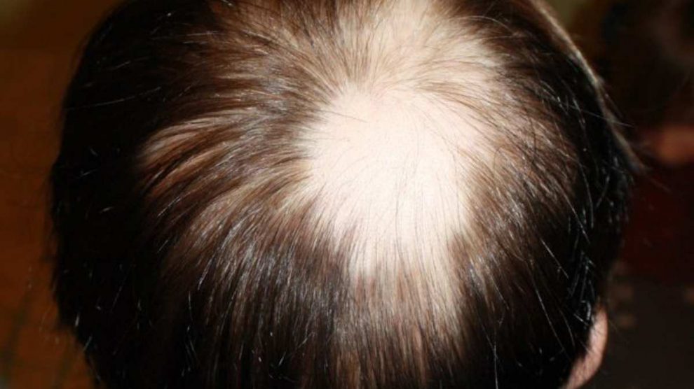 Pérdida de cabello en mujeres: causas y soluciones terapéuticas