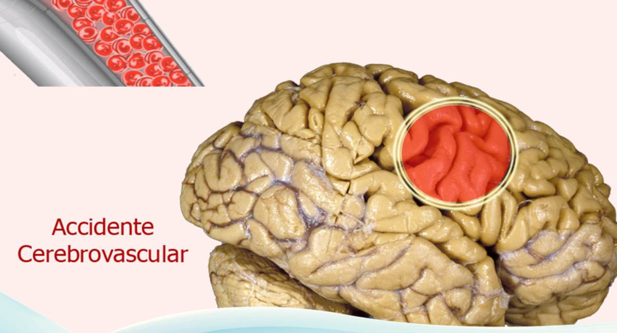 ¿Sabes lo que es un absceso cerebral?
