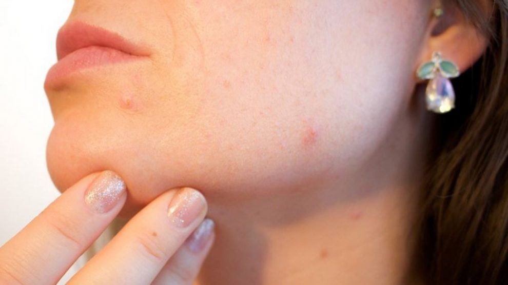 Urticaria Por Estrés Síntomas Y Tratamiento