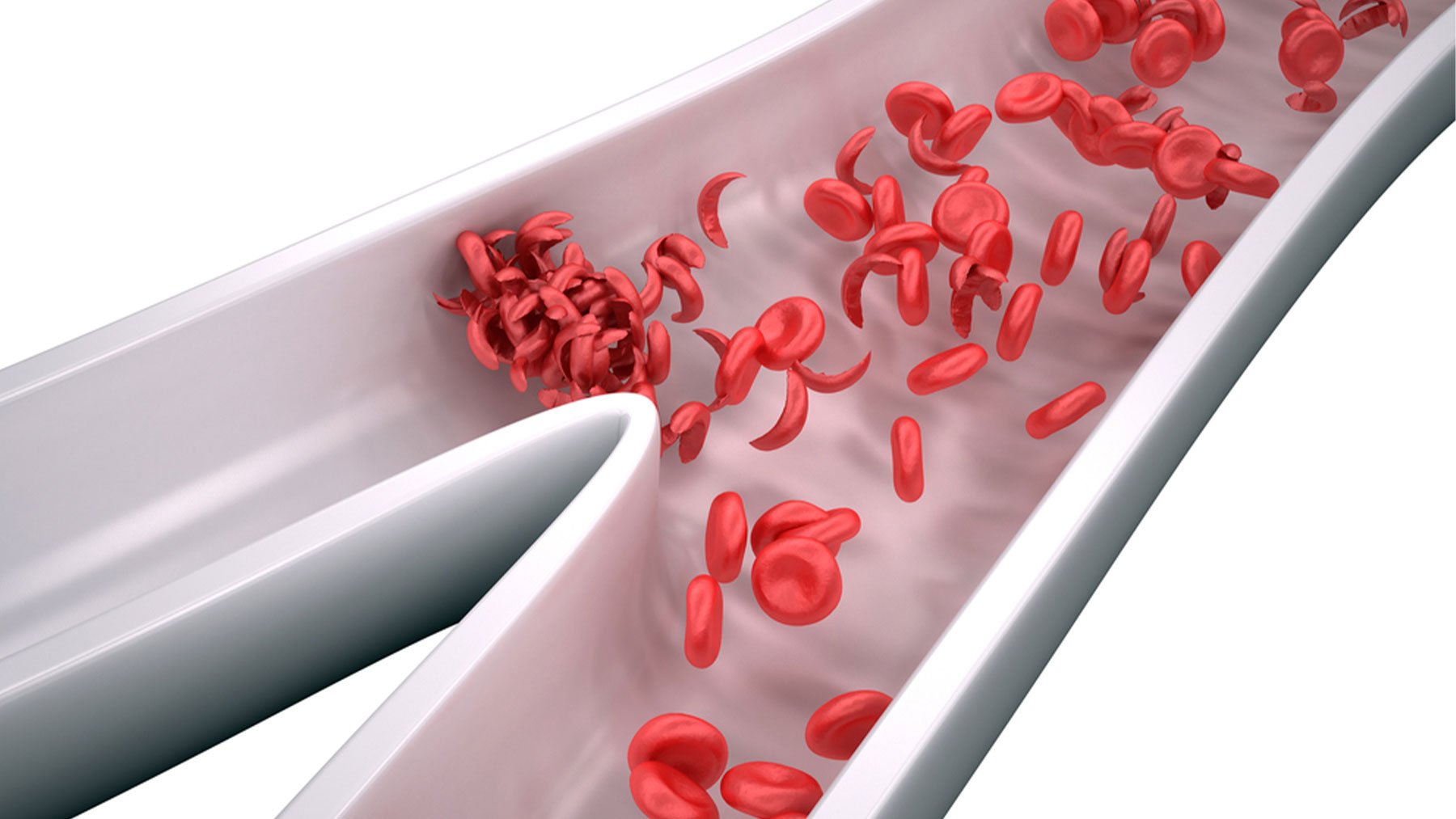 La enfermedad de células falciformes afecta a cerca de 1.200 personas ...