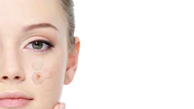 Top tratamientos para eliminar manchas de la piel