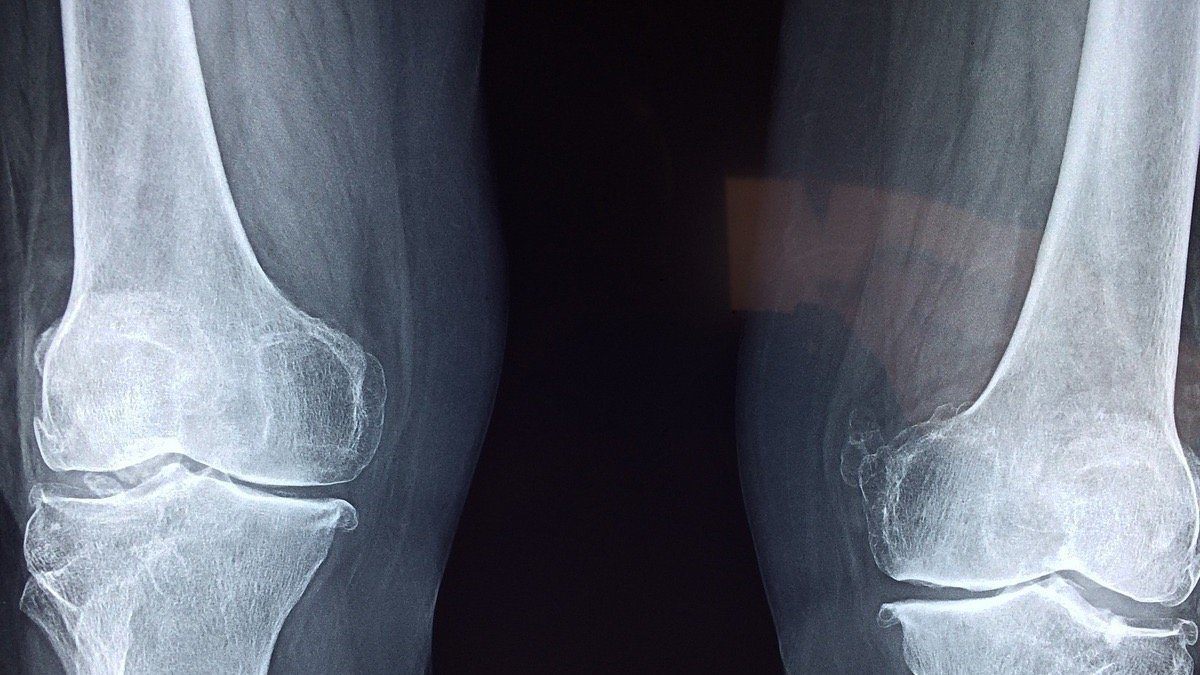 Artralgias: Causas, síntomas y tratamiento para el dolor articular