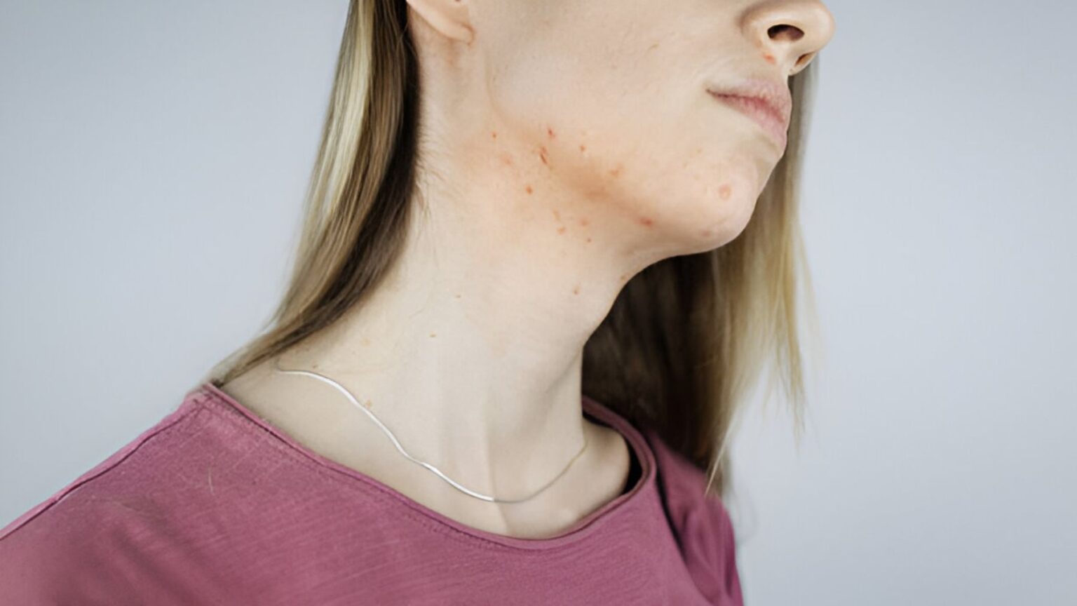 Do you have pimples on your neck? Try these 7 home remedies for neck acne